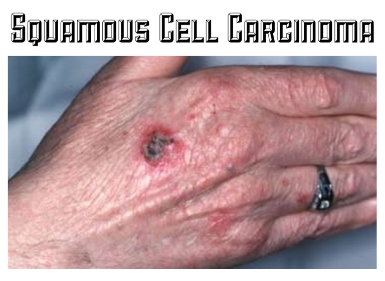 The ABCD Method of Early Skin Cancer Detection - Sarah Interman ...